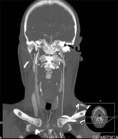 ICT sur thrombose carotide primitive – SSVQ